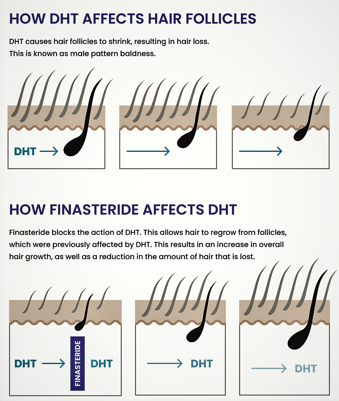 Hair Transplant Without Finasteride