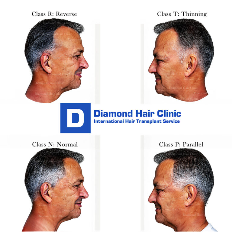 Hairline Design in Hair Transplant Surgery