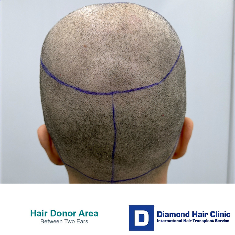 Beard and Chest Hair as Donor Sources for Hair Transplant
